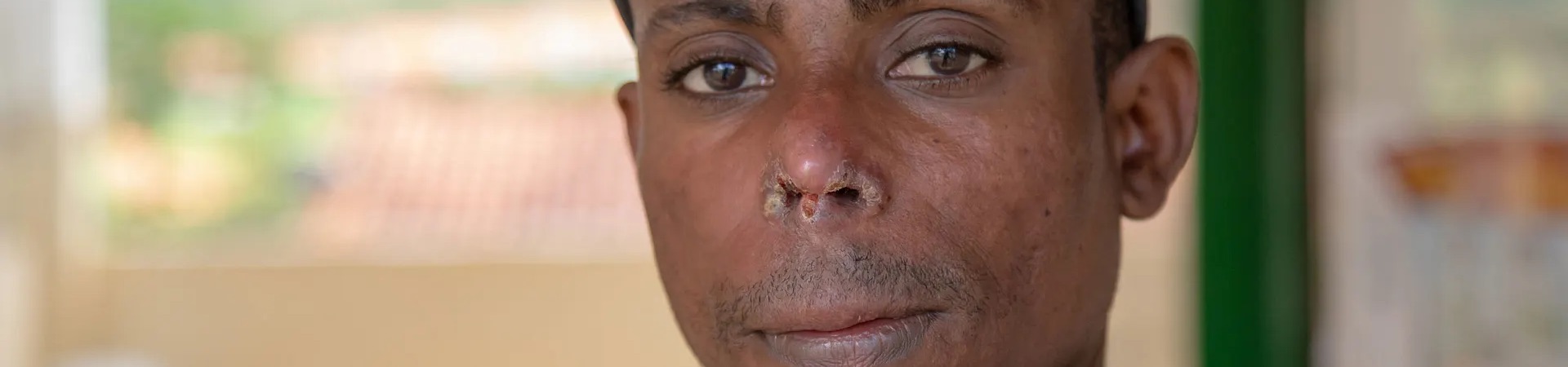 Miltefosina + termoterapia para leishmaniose cutânea | DNDi América Latina